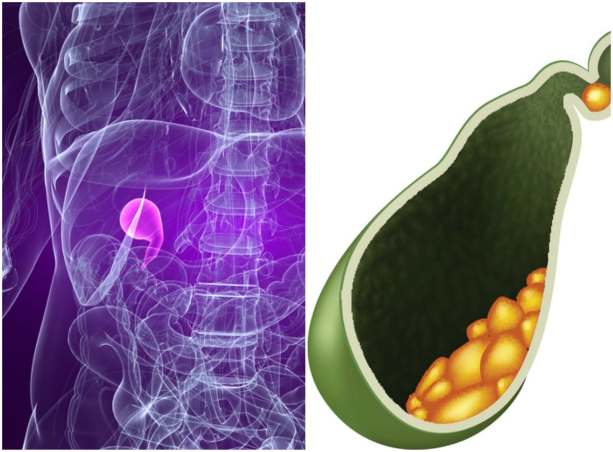 Akým potravinám a nápojom sa treba vyhýbať po operácii žlčníka ...